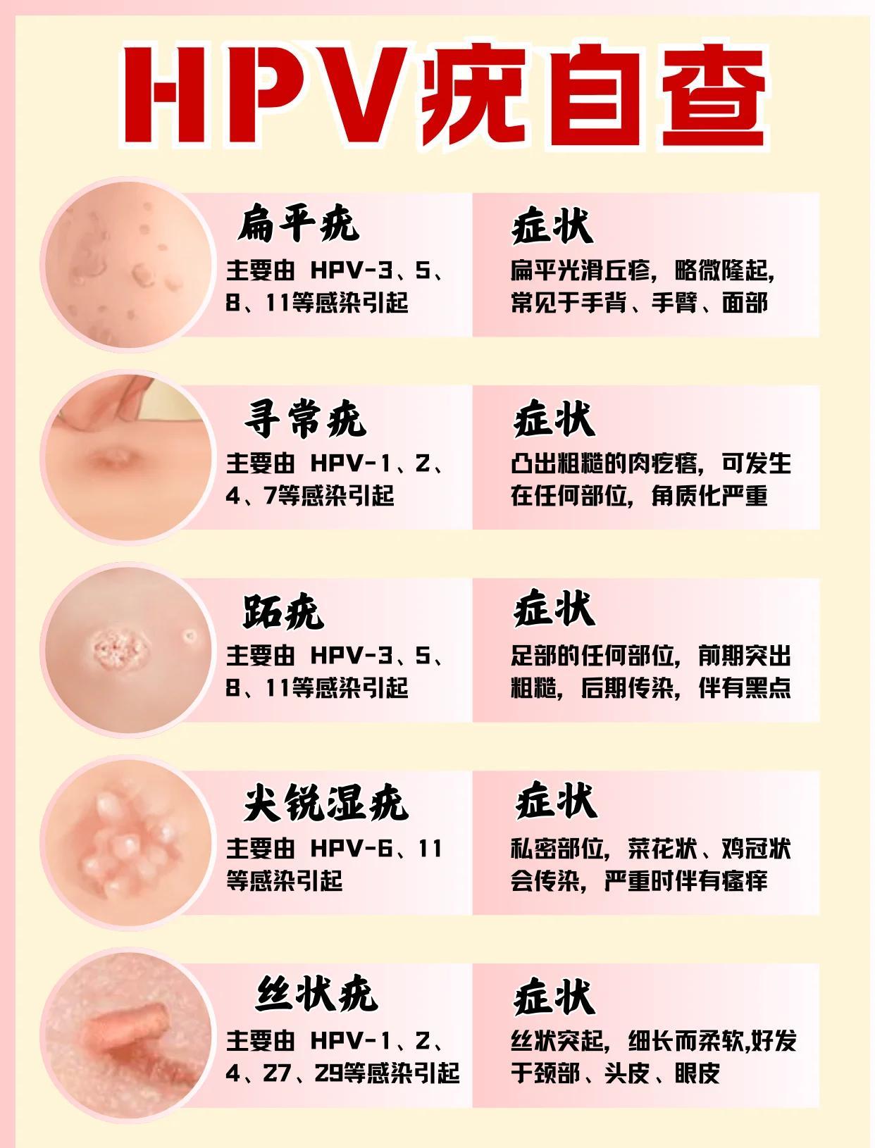 轻松辨别HPV疣类型，科学护理不再迷茫