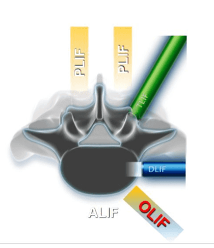 OLIF（斜前方入路腰椎椎间融合术）到底微创在哪里？