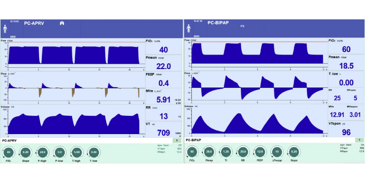 气道压力释放通气（APRV）详解