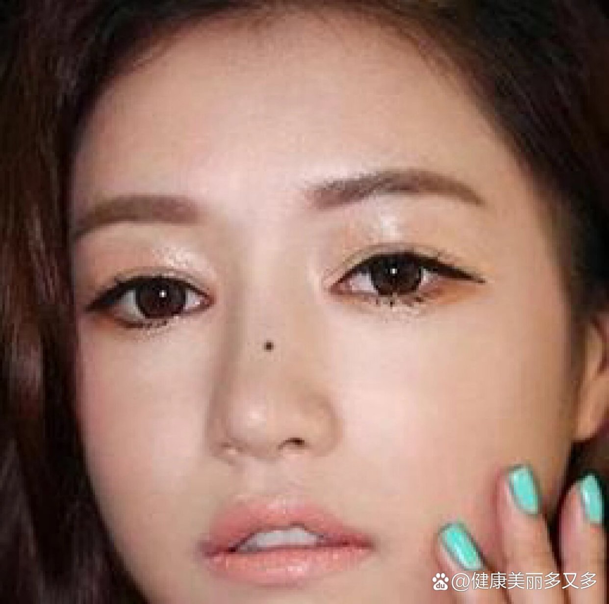 鼻子三角区长痣好不好