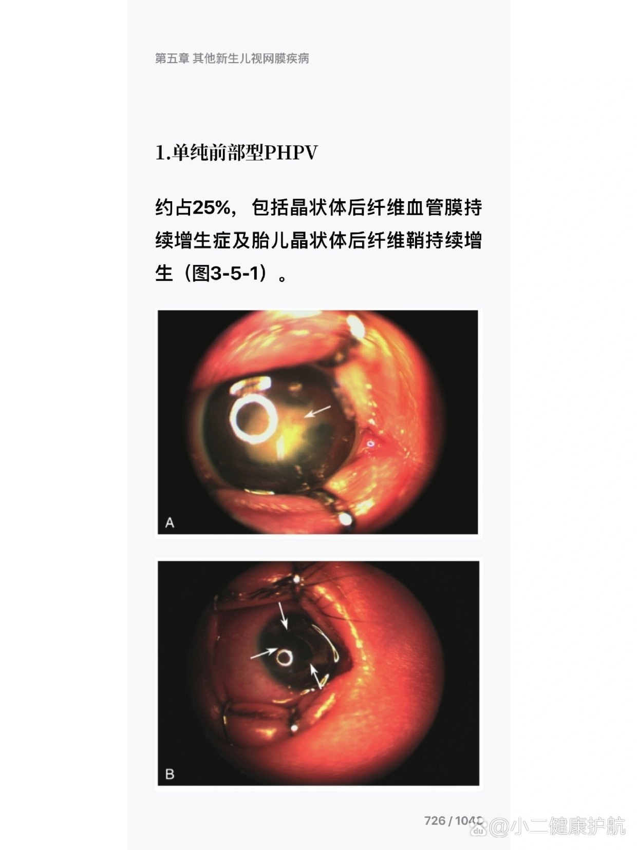 认识儿童眼病3-phpv/pfv永存原始玻璃体增生