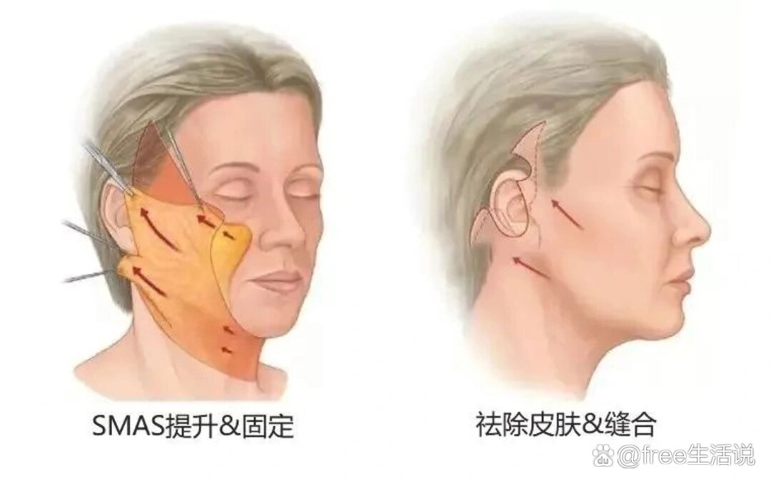 什么是SMAS层，它是干啥用的？