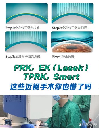 PRK,EK,TPRK,Smart近视手术方式你懵了吗？