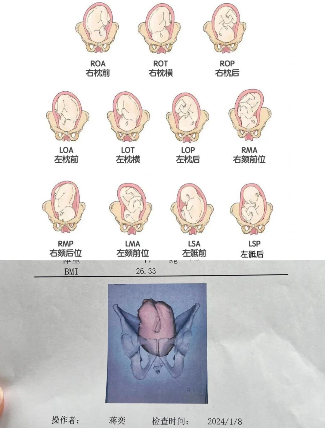 孕晚期11种胎方位详解，顺产妈妈必看！