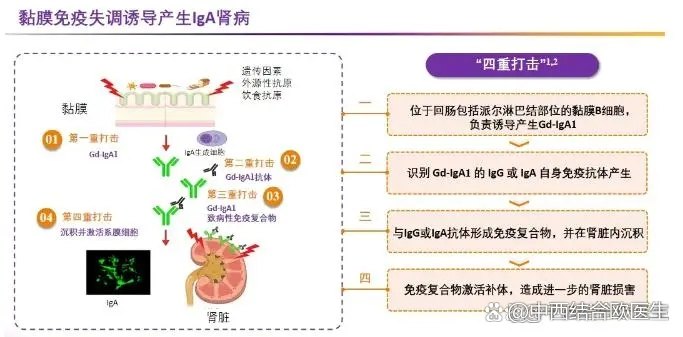 同样是激素，为什么布地奈德缓释胶囊（Nefecon）是首个对因治疗的药物？