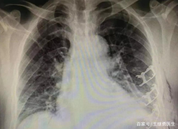 张力性气胸主要的病理生理变化是什么？