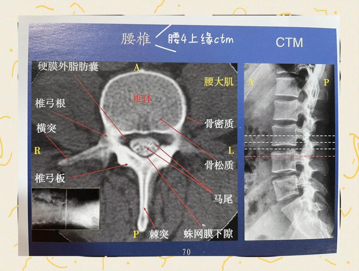 腰椎CT解剖详解：正常与异常表现