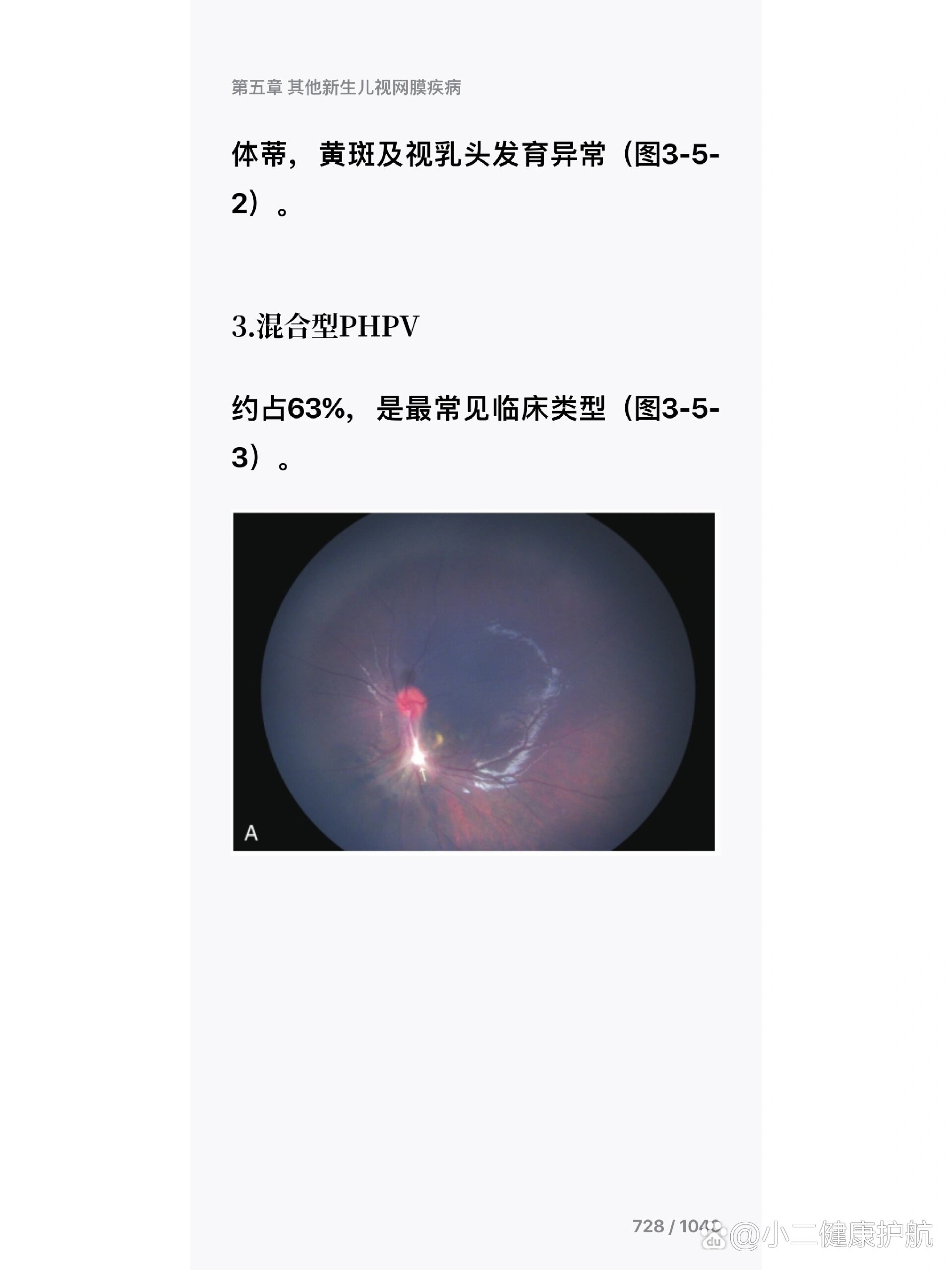 认识儿童眼病3-phpv/pfv永存原始玻璃体增生