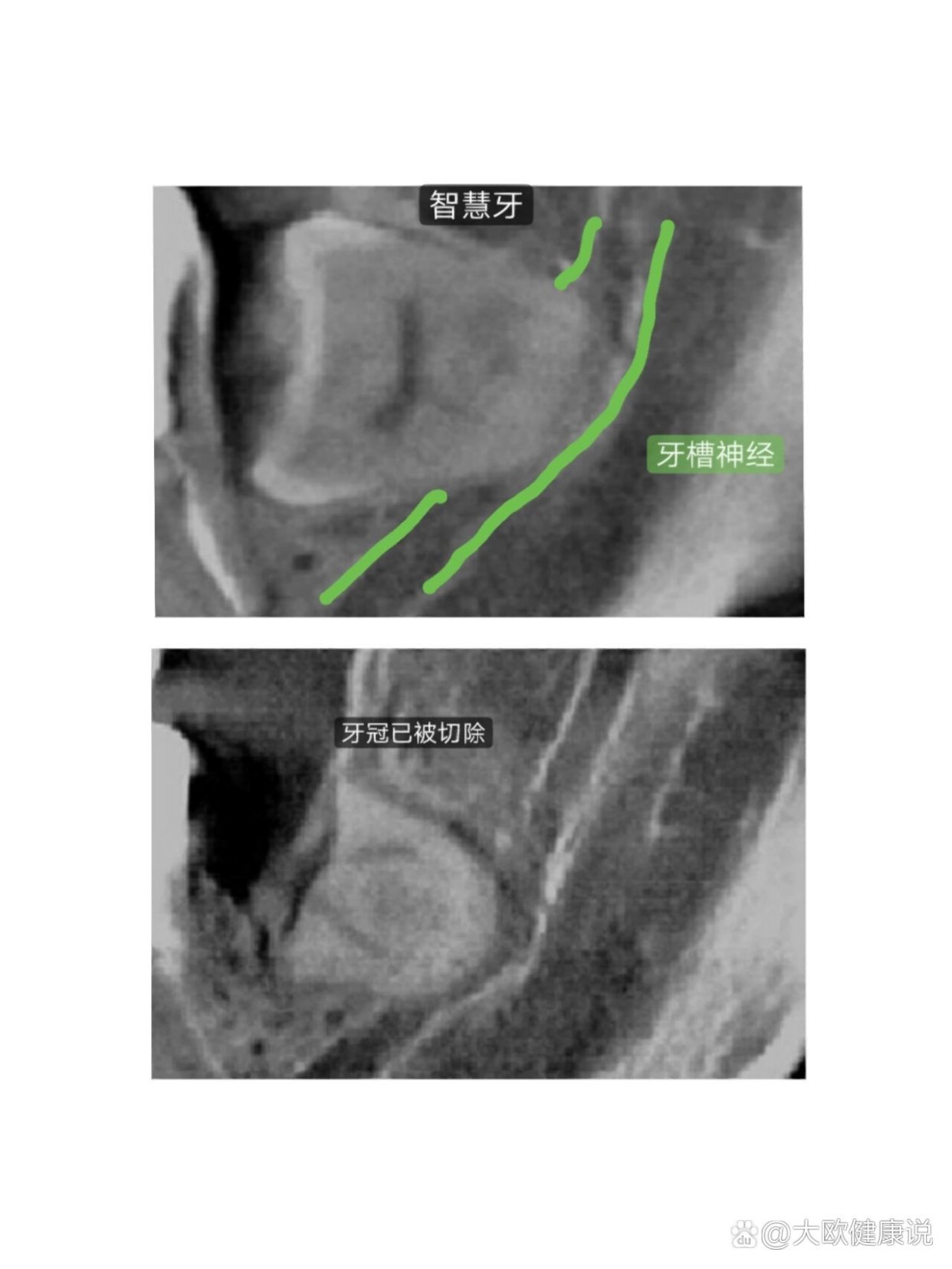牙冠切除术(coronectomy)