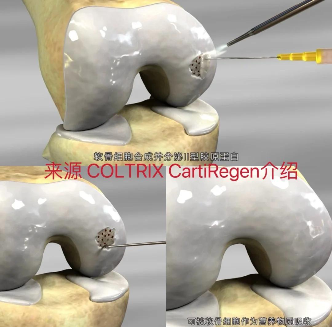 软骨修复手术ACIC技术：CF与CR对比