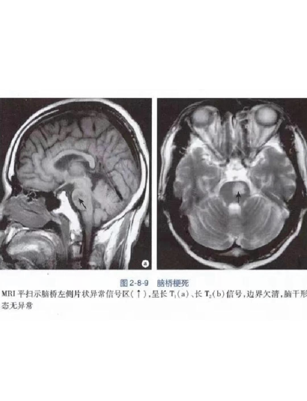 腔隙性脑梗死：CT、MRI表现全解析