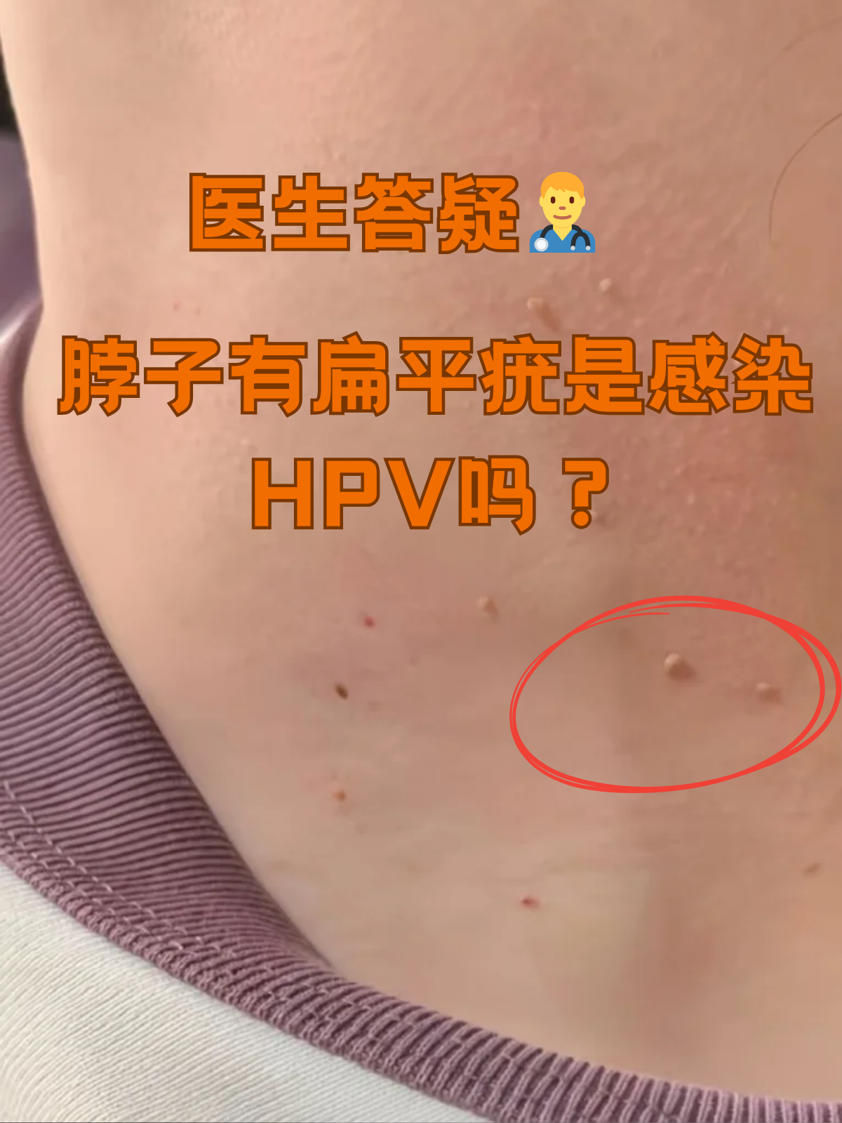 医生答疑👨‍⚕️脖子有扁平疣是感染HPV吗？