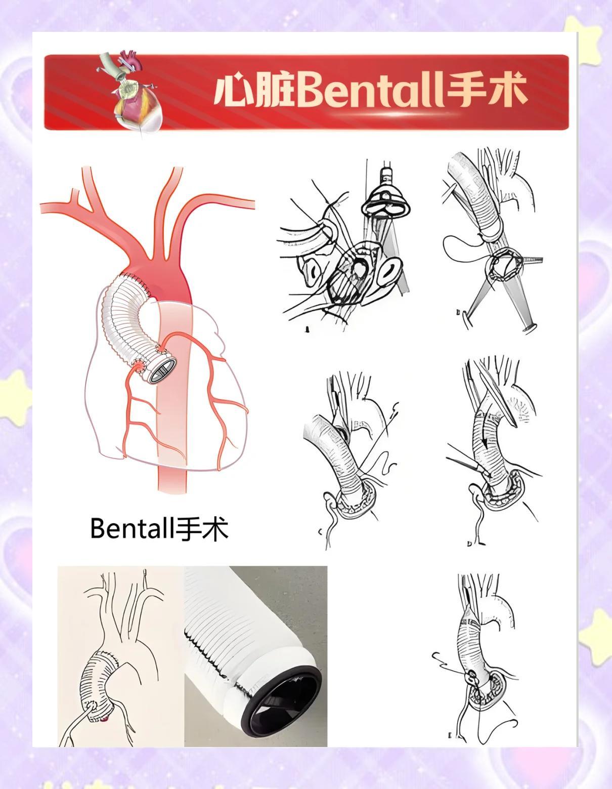 心脏外科挑战：Bentall手术揭秘