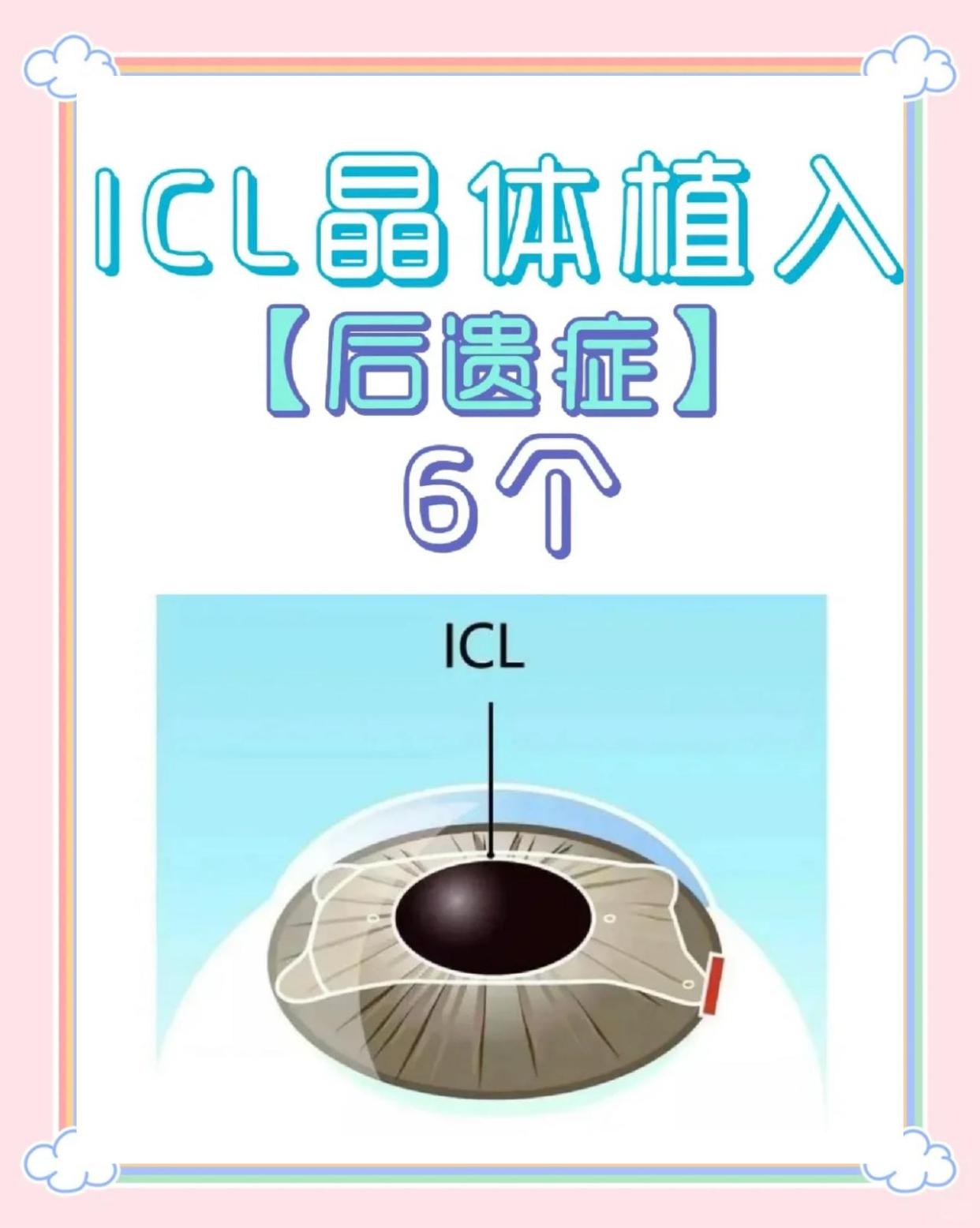 ICL晶体植入手术可能出现的6个后遗症